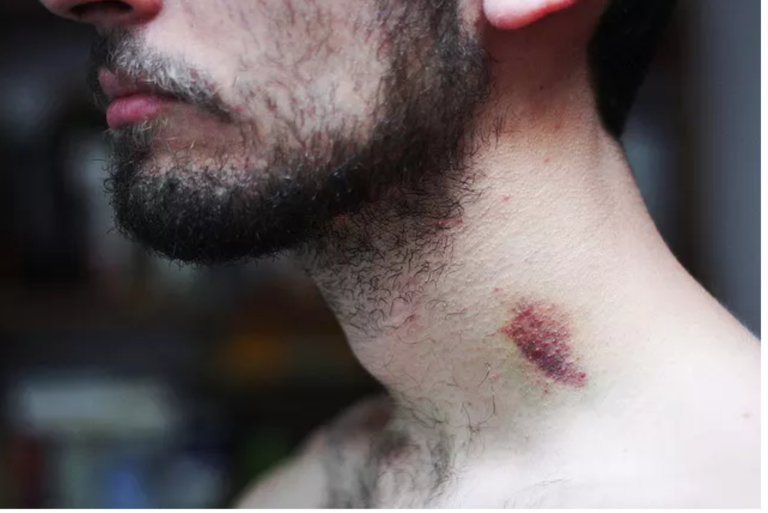 What Your Hickey Says About You | The Daily Nexus
